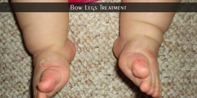 Understanding Various Aspects of Bow Legs Treatment | Kids Orthopedic