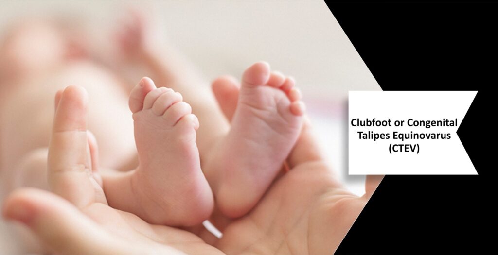 Congenital Clubfoot: Symptoms And Causes | Kids Orthopedic Clinic