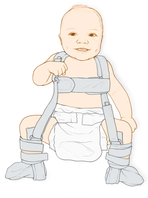 Congenital Hip Dislocation Signs and Symptoms In Baby