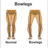 Bow Legs: Causes, Symptoms, and Treatment Options